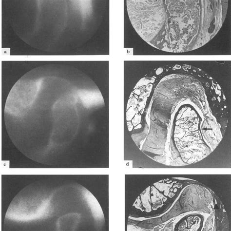Wilkes Classification Of Tmj Internal Derangement Download Table
