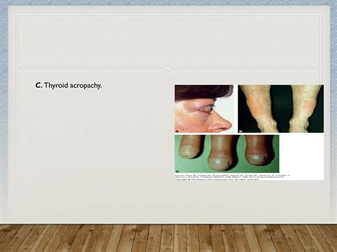 Hyperthyroidism Mainly From Harrison Pptx