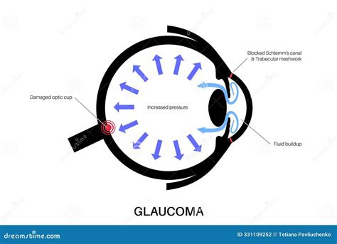 Glaucoma Eye Pressure Vector Illustration 325728810