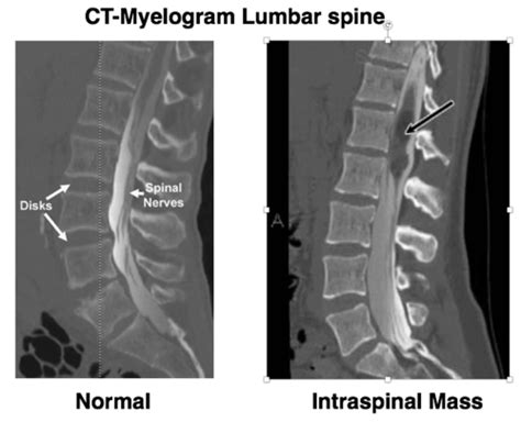 Myelogram Herniated Discs