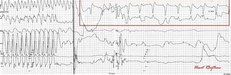 Pulseless Electrical Activity Ecg Strip