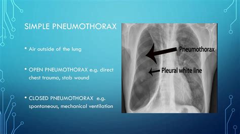 Open Pneumothorax Vs Tension Pneumothorax