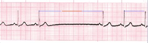 Sinus Exit Block Sinus Rhythms 313