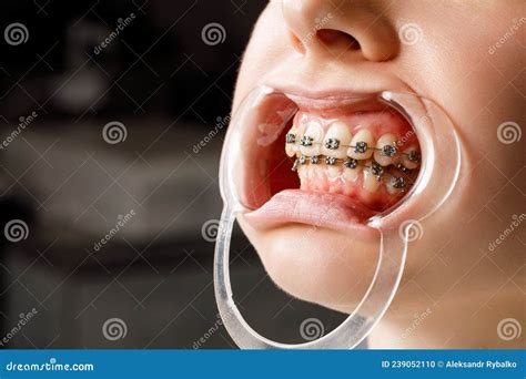 A Young Woman With Metal Braces Is Being Examined By An Orthodontist Correction Of The Bite Of