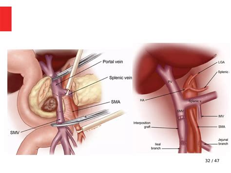 Whipples Procedure Indications Steps Complications Pdf