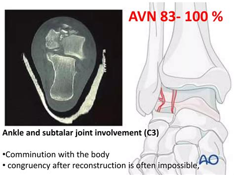 Talus Body Fracture Management Ppt