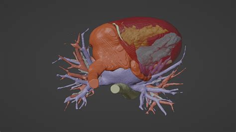 3d Model Of Human Heart With Tetrology Of Fallot Tof By Azekapeka