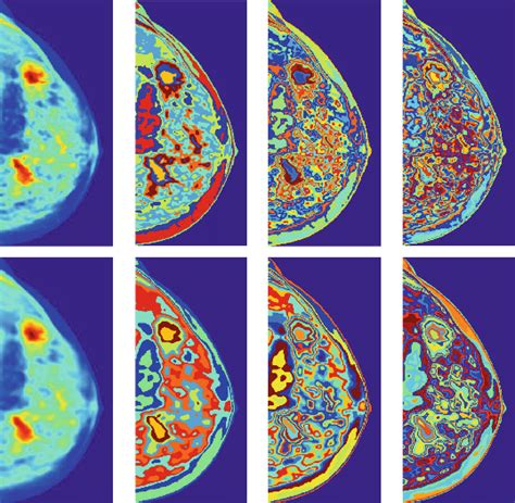 influence of pre processing σ parameter in modified fcm segmentation