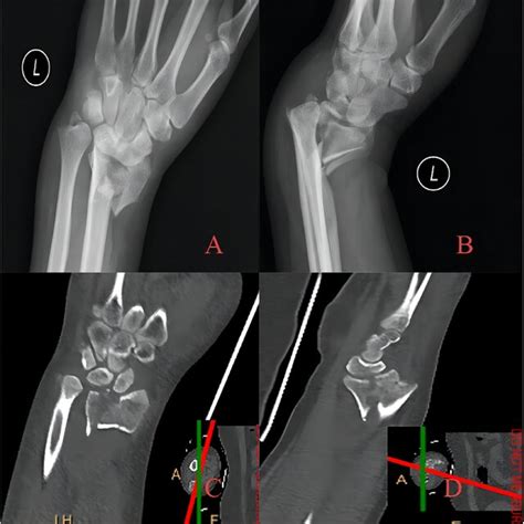 A 38 Year Old Patient With Die Punch Drf Radiography Data Showed A