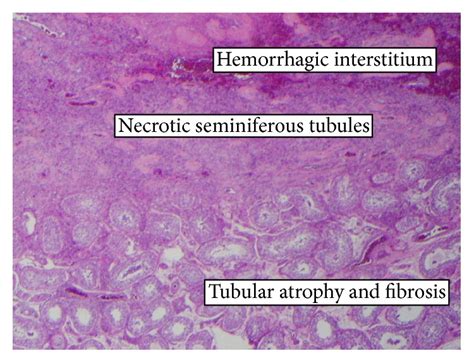 Segmental Testicular Infarction An Underdiagnosed Entity Case Report
