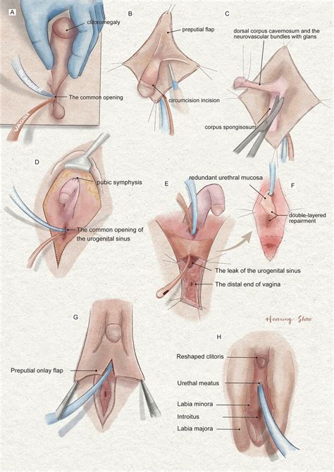 Frontiers Diagnosis And Surgical Decision Making Of A 46 Xx