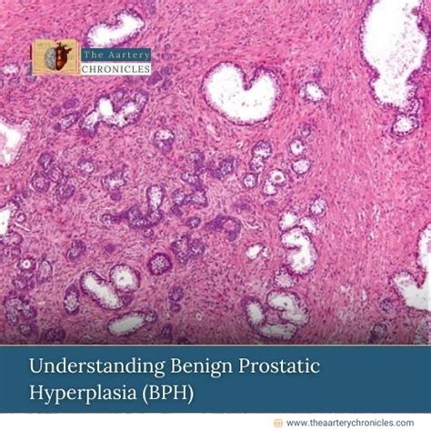 Benign Prostatic Hyperplasia Bph
