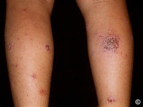 Eczema Circular Rash