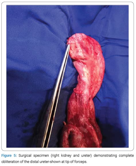 Right Sided Pyoureteronephrosis Due To A Giant Megaureter Causing Left