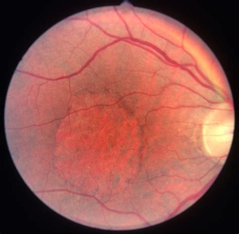 Central Areolar Choroidal Dystrophy Case 1 Right Eye Retina Image Bank