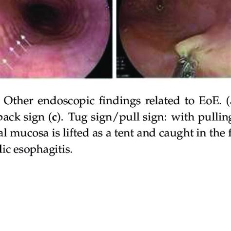 The Eoe Endoscopic Reference Score Erefs Download Scientific Diagram