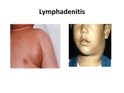 Lymphangitisppt
