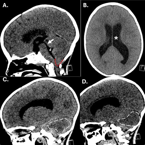 Lumbar Puncture And Brain Herniation In Acute Bacterial Meningitis An