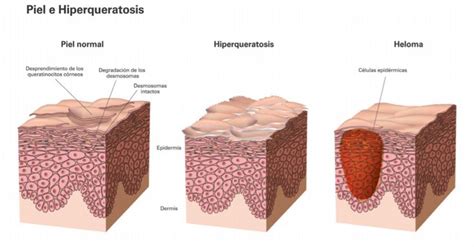Hiperqueratosis Y Helomas Salud De Los Pies Celulas Consejos