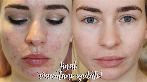 Final 8 Month Roaccutane Update Youtube