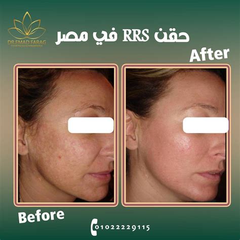 حقن Rrs في مصر دكتور تجميل دكتور عماد فرج