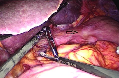 The Laparoscopic View Showed The Gastric Serosal Surface Of Lesion Was Download Scientific