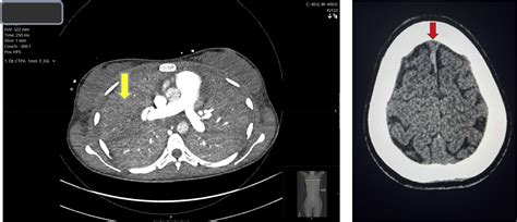 Staphylococcus Aureus Infective Endocarditis Jacc Patient Pathways Jacc