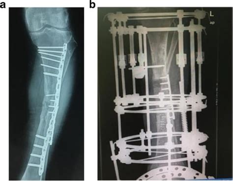 Postoperative Osteomyelitis Ppo Following Fracture Fixation The