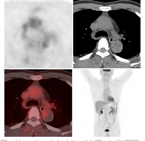 Figure 1 From Primary Aortic Sarcoma In Arch And Descending Aorta A
