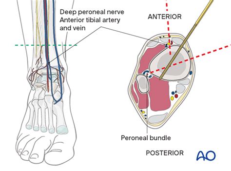 Safe Zones For Pin Placement In The Pediatric Tibia