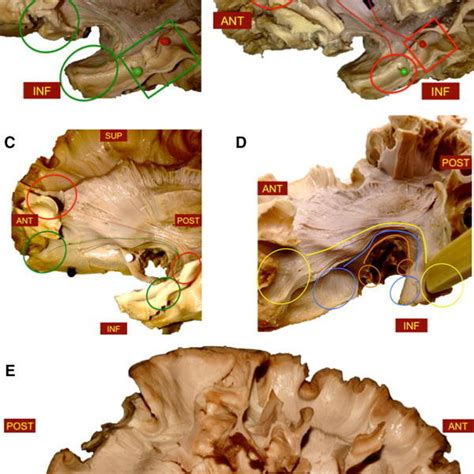 View Of The Fronto Temporal Opercular Region With The Exposed Uf Stem