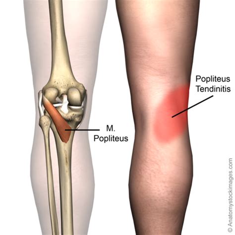 Popliteus Tendinopathy Physiopedia