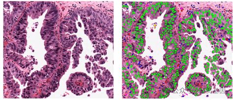 Nat Gen ｜ 空间转录组学分析揭示胰腺癌的肿瘤微环境异质性 知乎