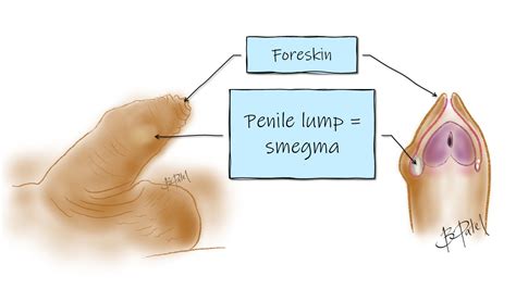 Smegma Under Skin
