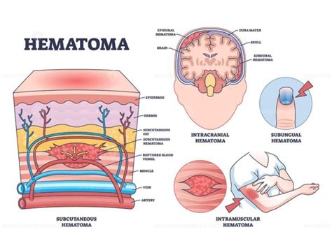 Hematoma Diagram Outline Shows Types Of Hematomas With Labeled Sections