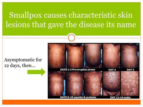 Ppt Smallpox Powerpoint Presentation Free Download Id 3061148