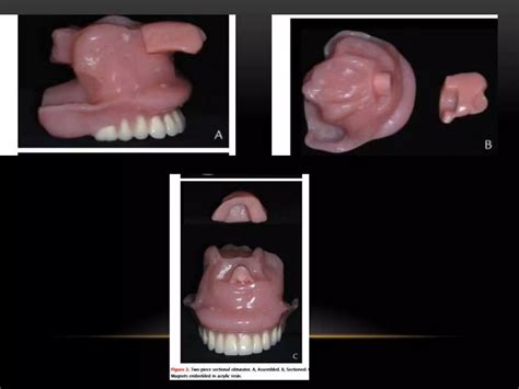 Hollow Obturator In Case Of Total Maxillectomy Pptx