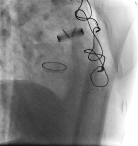 Second Fluoroscopy Notes This Image Was Taken 48 Hours After