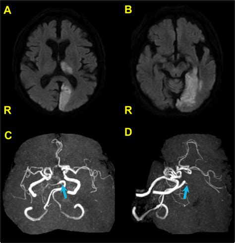 A B Mri Dwi Pca C D Mra Pca Download Scientific Diagram