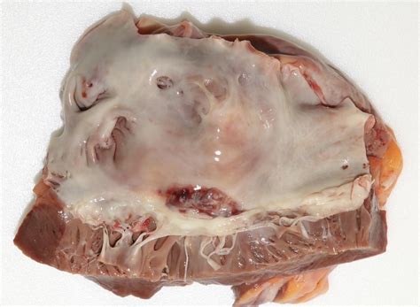 Bacterial Endocarditis R Pathology