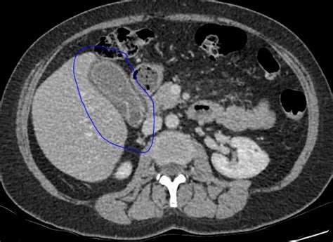 Ultrasound Diagnosed Gallstones That Were Radiolucent On A Recent Ct