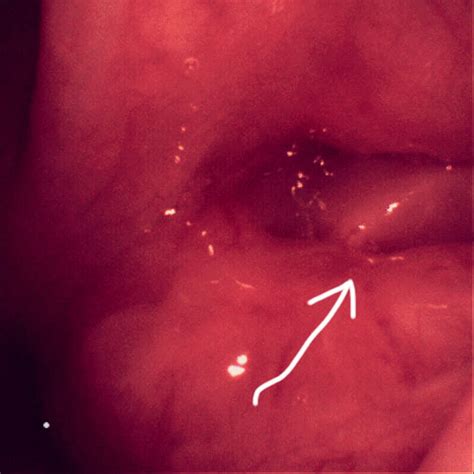 Laser Tonsillectomy For Tonsil Stones And Bad Breath