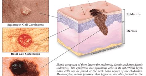 Testimoni Kanser Kulit Sembuh Selepas 4 Minggu Dengan Vivix