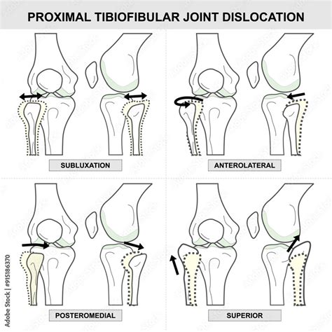 Proximal Tibiofibular Joint Dislocation Illustration Stock Vector