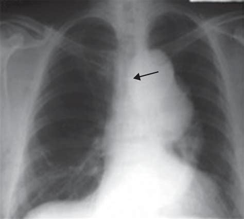 Thoracic Aortic Aneurysm Resection Clinical Tree