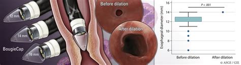 Endoscopic Esophageal Stricture Dilation At Edgar Portis Blog