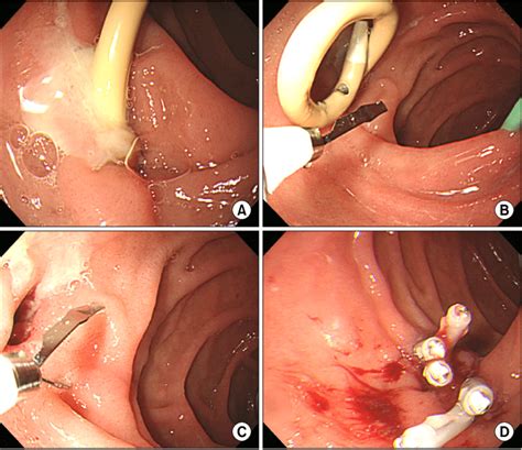 Upper Gastrointestinal Endoscopy A Duodenal Perforation Caused By