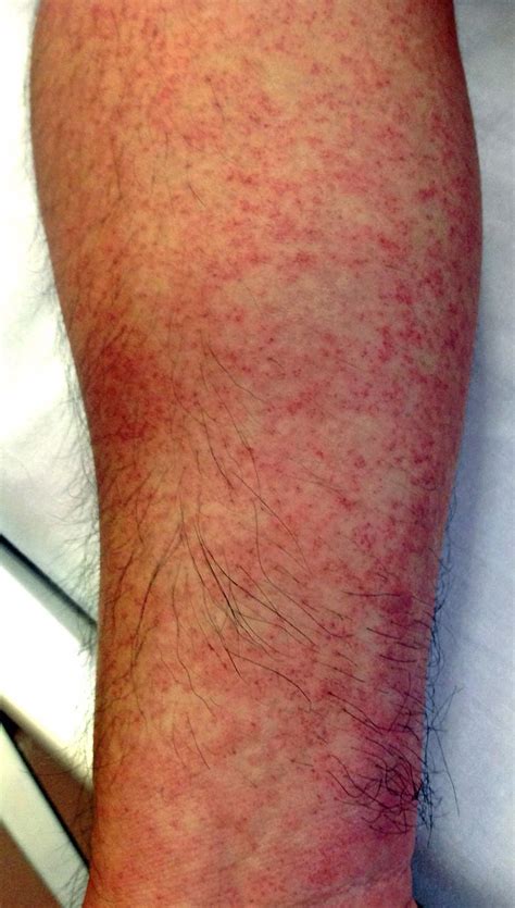 Dengue Rash