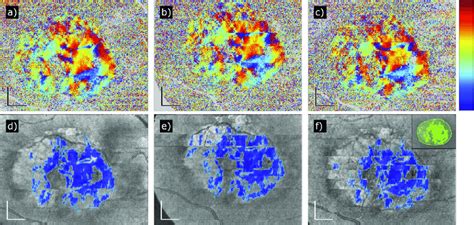 Repeatability Of Fibrosis Segmentation Three Measurements Of The Same Download Scientific