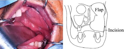 Incision Was Made From Buccal Side Of Sutured Edge In Abdominal Rectus